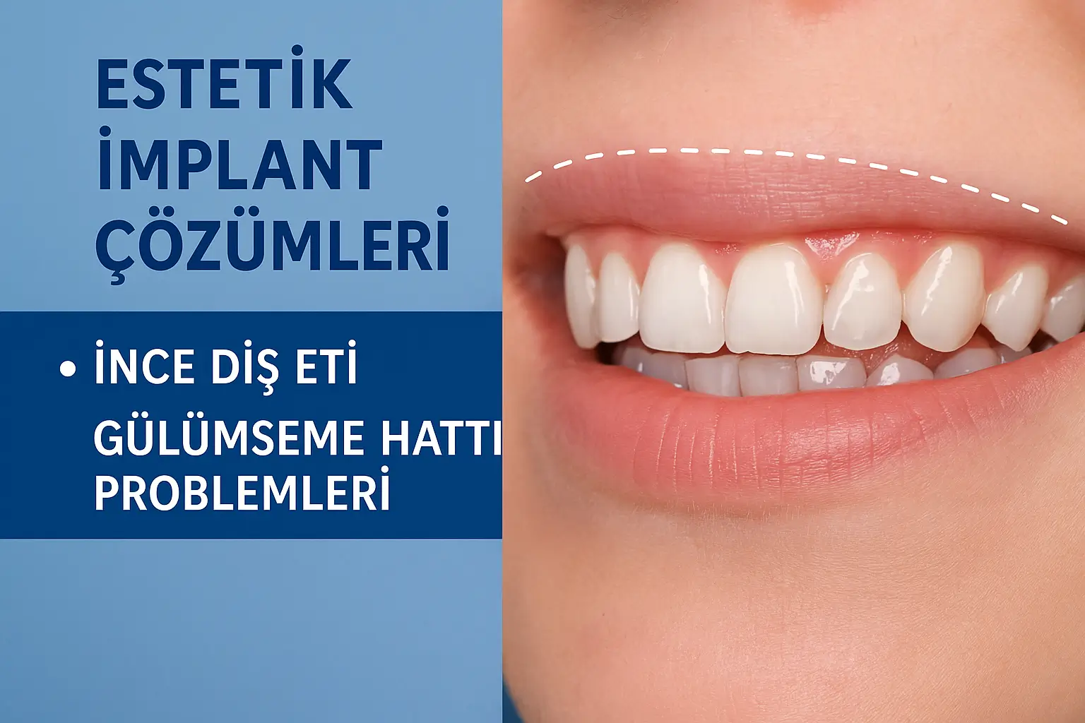 Estetik İmplant Çözümleri: İnce Diş Eti ve Gülümseme Hattı Sorunları